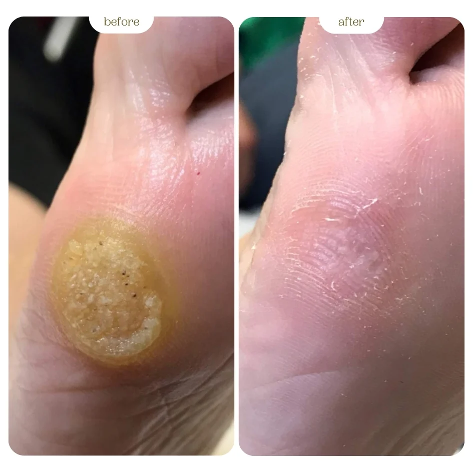 Warts Removal - SkinLab Aesthetics